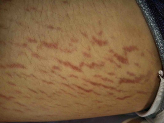 Symptoms Of Anaphylactoid Purpura Life Care Many Health Issue
